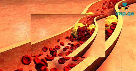 მიიღეთ ამ სასმელის 4 სუფრის კოვზი ყოველ დილით და დაემშვიდობეთ დაბლოკილ არტერიებს არტერიულ მაღალ