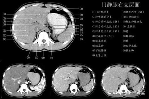 经典懂腹部CT 知乎