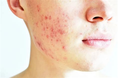 Acné Conglobata Causas Y Síntomas Mejor Con Salud