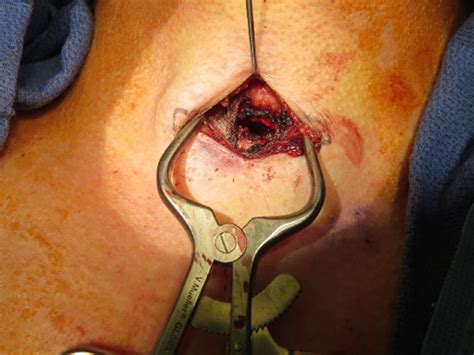 Cricothyrotomy For Elective Difficult Airway Management Iowa Head And