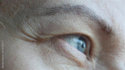 Middle Aged Females Eye With Drooping Eyelid Ptosis Is A Drooping Of