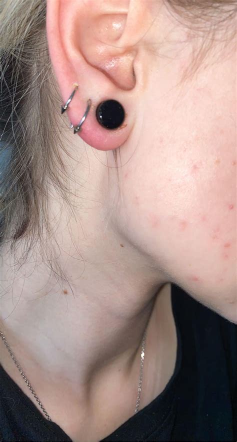 Help Infected Gauge 🥲 Ive Been Stretching My Ears For Over A