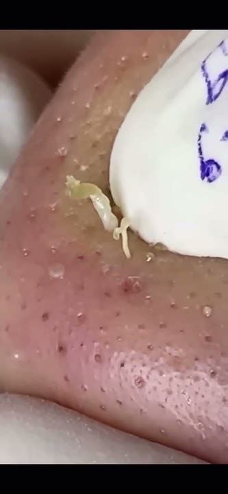 피부 피지 마사지 여드름 추출 피지제거하는영상 쏙쏙제거😁 Youtube