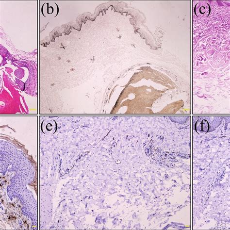 Clinical And Dermoscopic Presentation Of Anetodermic Pilomatricoma A Download Scientific