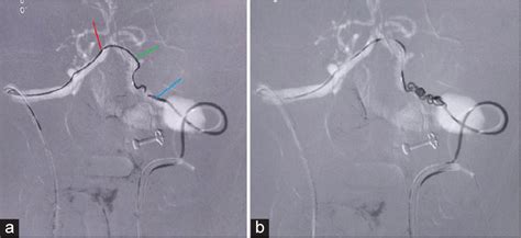 Distal Vertebral Artery Pseudoaneurysm Coiling Using Dual Microcatheter