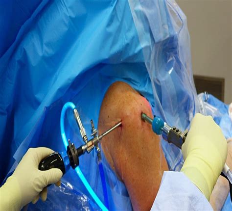 Shoulder Labral Repair Surgeon Researcher