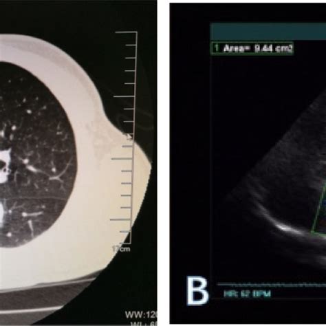 A Computed Tomography Imaging Scans Identified A Right Upper Lobe Download Scientific Diagram