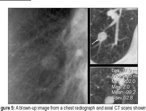 Figure 1 From The Calcified Lung Nodule What Does It Mean Semantic Scholar
