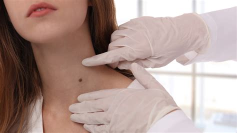 Skin Tag Vs Mole The Real Difference Between The Blemishes