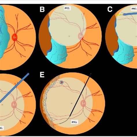 A The Temporal Side Of Retina Was Noted To Have A Rolled And Stiffened