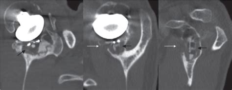 Cancellous Bone Osteolysis Indicated By The Black Arrows And Cortical