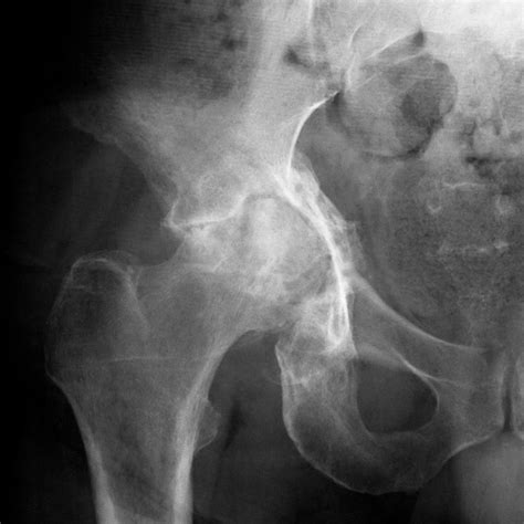 Arthritis Hip Operation At Mary Wilber Blog