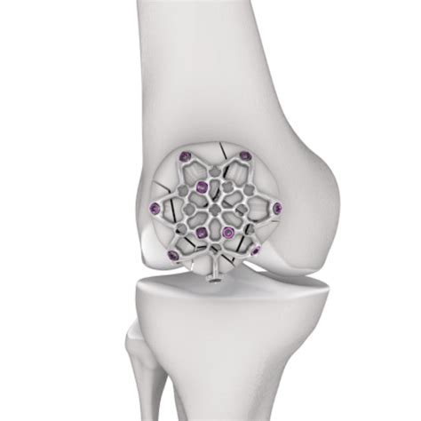 Variable Angle Locking Patella Plating System Kalteq