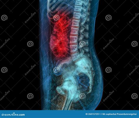 Ct Colonography Or Ct Scan Of Colon 3d Rendering Image For Screening Colorectal Cancer Check Up