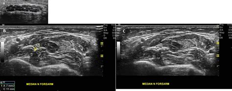 Neuromuscular Ultrasound Of The Median Nerve At The Carpal Tunnel