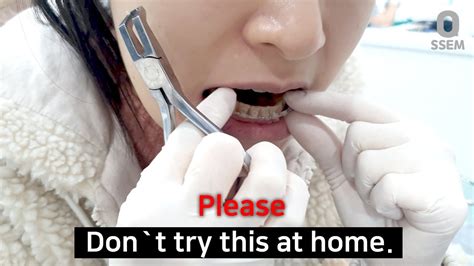 셀프교정 치과위생사 10년차되면 브라켓와이어도 스스로 뗀다 치아교정 마무리디본딩 Youtube