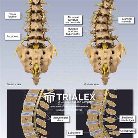 Lumbar Spine Condition Trialexhibits Inc