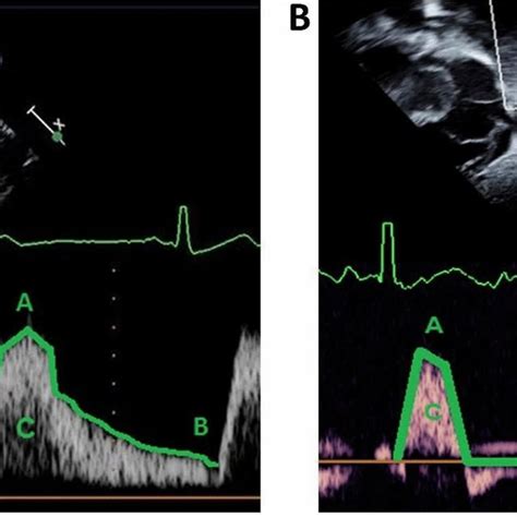 Calculation Of Pulsatility Index Standard PI Is Represented In A In Download Scientific