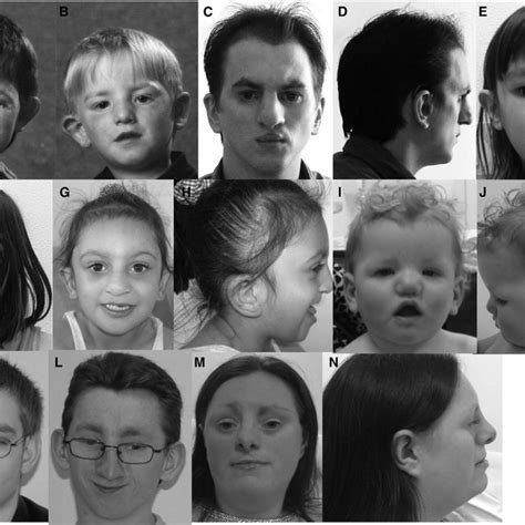 Facial Phenotype Of Individuals With Bmks A And B Persons Iii1 And