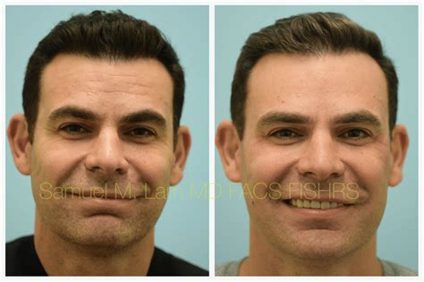 Dallas Botox Before And After Photos Plano Plastic Surgery Photo Gallery Dr Sam LamPatient