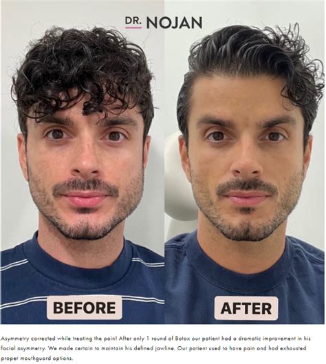 Botox Dr Nojan Bakhtiari Tmj Oral And Facial Pain Specialist Botox Dr Nojan Bakhtiari Tmj Oral And Facial Pain Specialist
