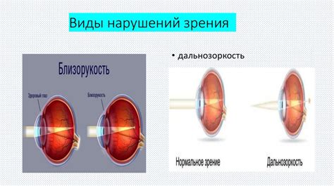 Дефекты зрения как сохранить зрение презентация онлайн