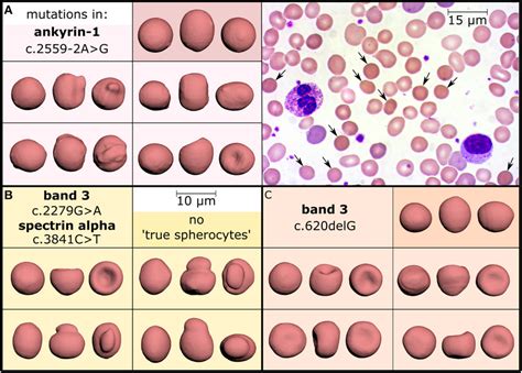 Spherocytosis Inheritance Ppt Spherocytosis Causes Symptoms