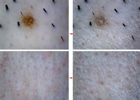 Hd Hair Scalp Scope Skin Diagnosis Analyzer With Professional Analysis