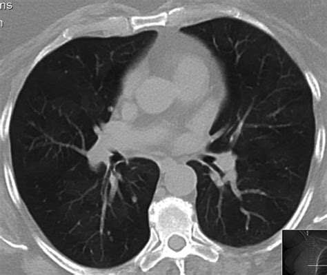 Chest CT Diffuse Bilateral Geographic Mosaic Attenuation And Bilateral Download Scientific