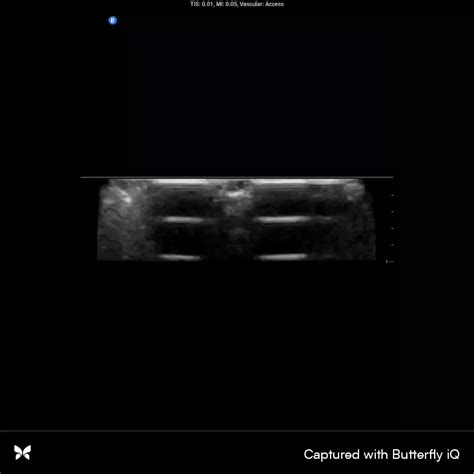 Vein Finder Object Detection Dataset By Capstone