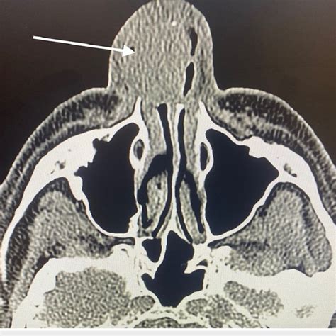 Axial Ct Scan Without Contrast At The Level Of The Maxillary Sinus In