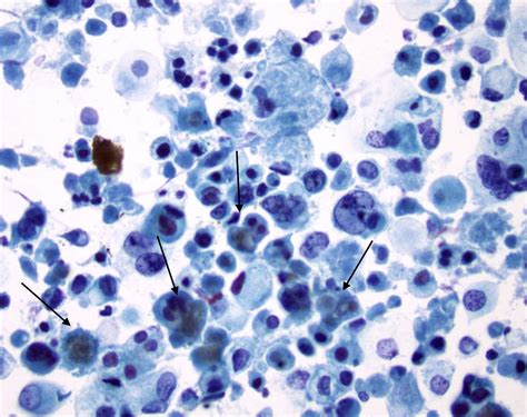 Hepatocellular Carcinoma Cytology
