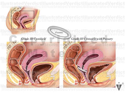 Cystocele Grading