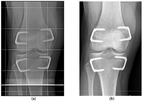 Proximal Fibula