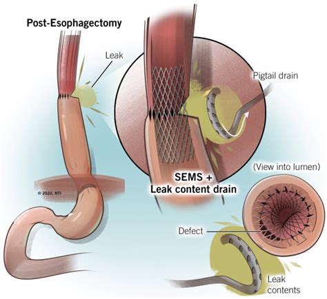 Living With A Metallic Stent What To Expect And How To Adapt