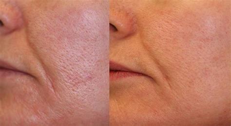 How To Shrink Pores