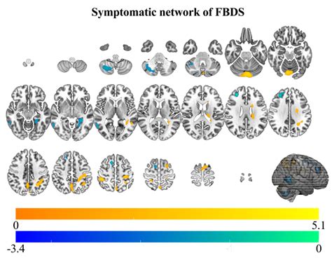 Whole Brain Metabolic Pattern Analysis Of Faciobrachial Dystonic