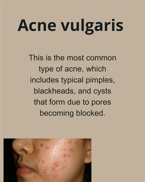 How To Get Rid Of A Zit Overnight 14 Steps With Pictures Artofit