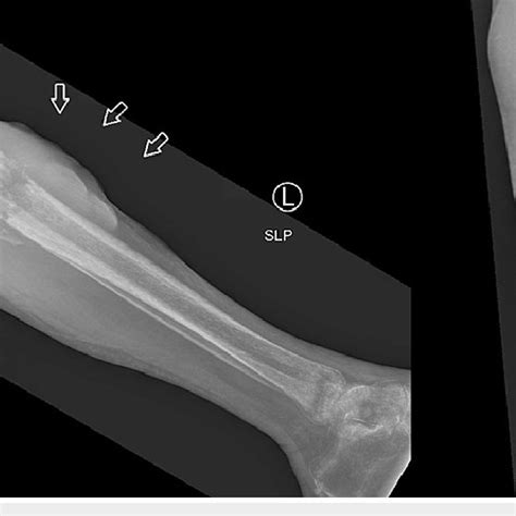 Radiographs From The Time Of Diagnosis Of Proximal Tibial Lymphoma Download Scientific Diagram