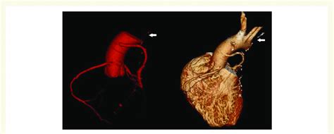 Three Dimensional Computed Tomography Reconstructions Demonstrating The Download Scientific