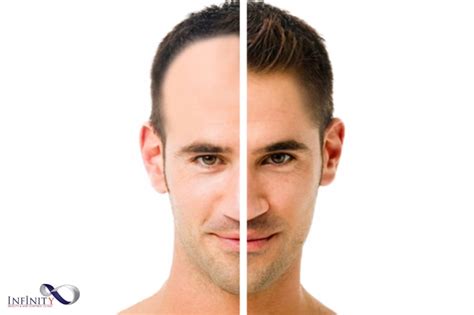 Лазерно лечение на косопад Infinity Clinic Sofia