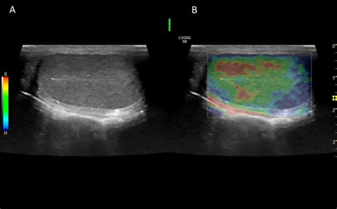 Representative Elastogram Acquired With The Qualitative Strain