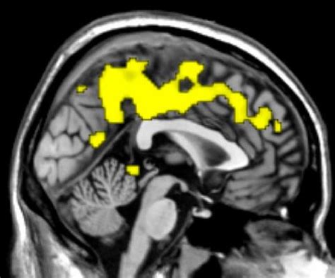 A Fuzzy Method For Interpreting Fmri Recordings Science Codex