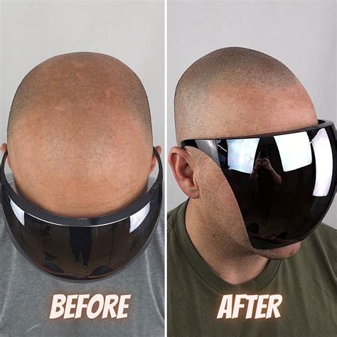 Scalp Micropigmentation Results Gallery Enhanced Scalp