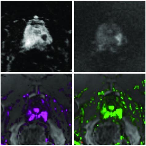 Pi Rads V2 1 Shows Excellent Performance In Assessing Dce Roc Analysis Download Scientific