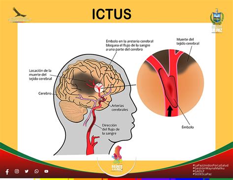 ¿quÉ Es El Ictus Sedes La Paz