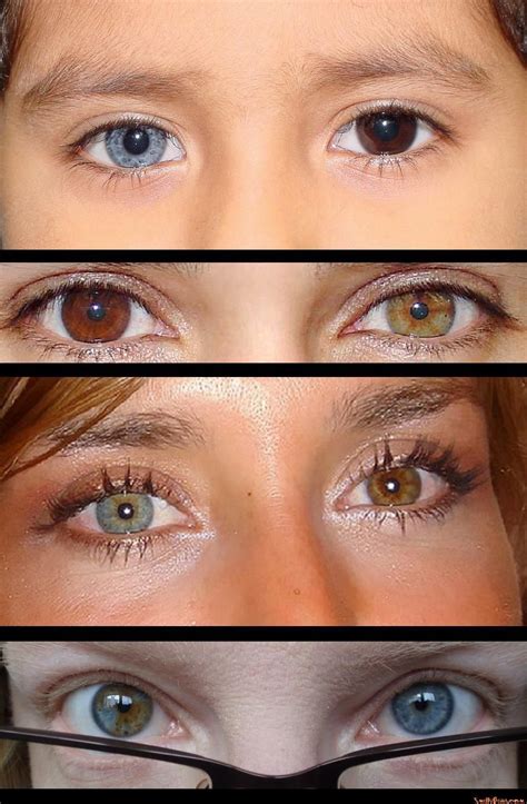 What Is It Called When You Have Two Different Colors In Your Eyes At