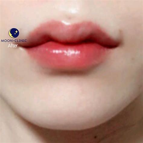 문클리닉 입술유지기간 길어진 이곳 문클리닉 입술입꼬리필러 사람마다 생김새가 다르듯 입술의 Facebook