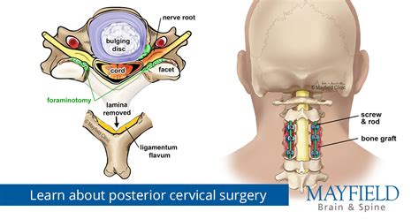 Discectomy And Laminectomy L4 And L5 Lumbar Spine Bilateral Laminectomy