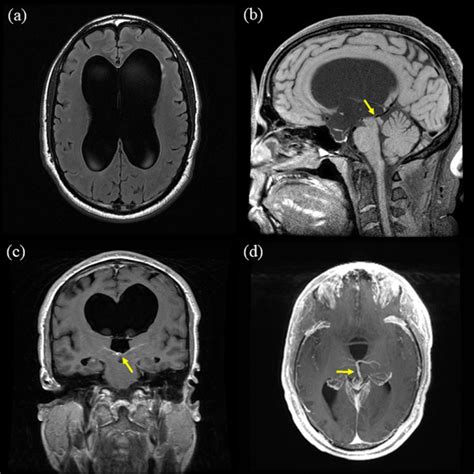 Obstructive Hydrocephalus Due To Aqueductal Stenosis From Developmental